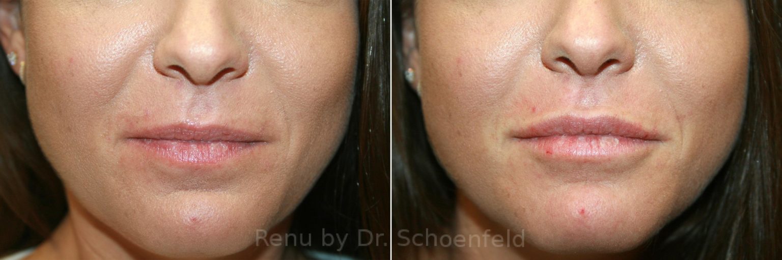Dermal Filler Photos | Chevy Chase, MD | Patient 12604